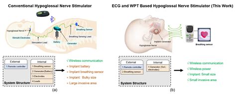 Minimally Invasive Hypoglossal Nerve Stimulator Enabled By Ecg Sensor