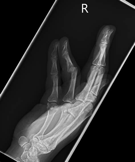 Dip Joint Dislocation At Flynn Trenwith Blog