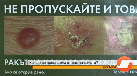 Как да се предпазим от рак на кожата Youtube