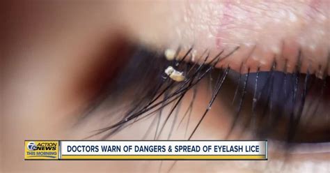 Doctors Warn Of Lice Found In Eyelash Extensions