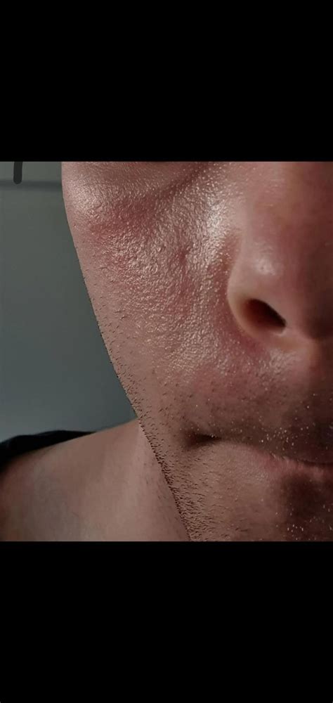 texture does it improve r accutane