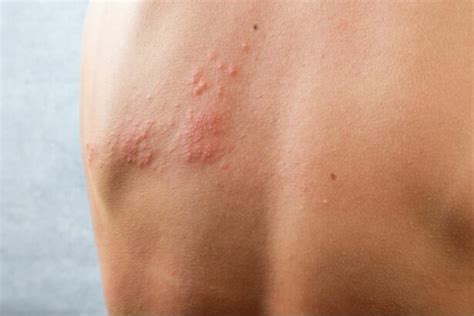 Quels Sont Les Différents Types De Boutons Sur Votre Peau