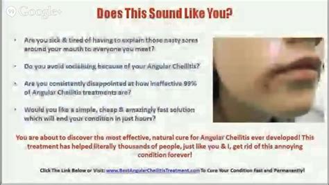 Angular Cheilitis Causes Symptoms Diagnosis Treatment
