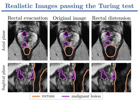 Data Augmentation Mri Medical Imaging Medical Image Computing Mic Dkfz German Cancer