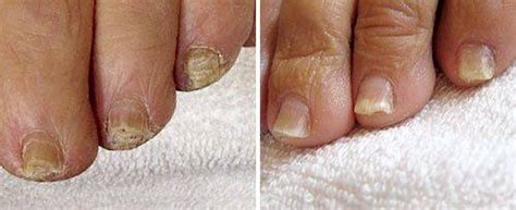 Treat Ugly Toenails With Laser Treatment Transform Clinic