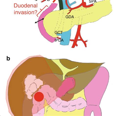 Preoperative Schema A The Mass Involves The Duodenum Transverse