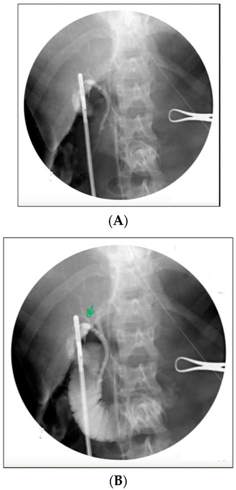 The Impact Of Intraoperative Glucagon On The Diagnostic Accuracy Of