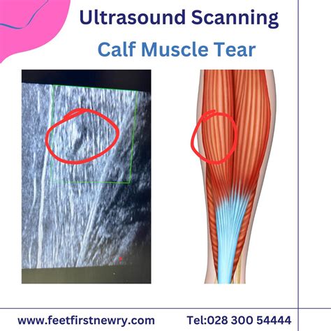 Calf Muscle Tear Feet First Newry