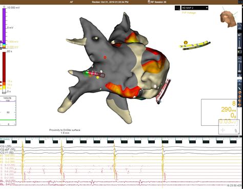 Advisor Hd Grid Mapping Catheter Se Case Library Abbott
