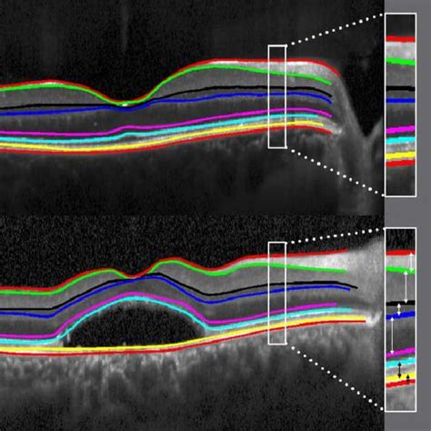 Segmentation Of Retinal Layers Horizontal Sd Oct From A Healthy