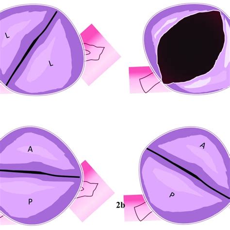 Partial Fusion Aortic Valve Figure Represents Three Cusps With Partial Download Scientific