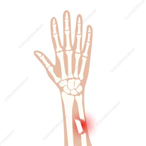 Fractured Arm Illustration Stock Image F041 3398 Science Photo Library