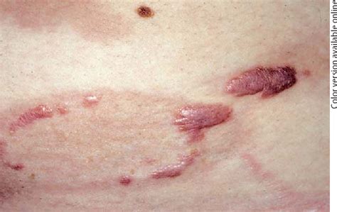 Figure 4 From Nodular Morphea Semantic Scholar