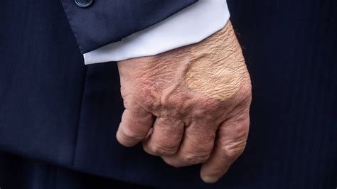 Trump Diagnosed With Chronic Venous Insufficiency After Undergoing