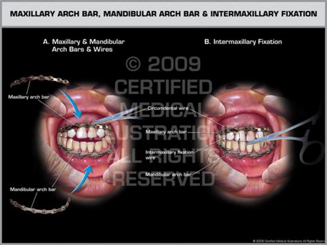 Maxillary Arch Bar Mandibular Arch Bar And Intermaxillary Fixation