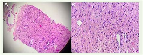 Multiparametric Mr Evaluation Of An Unusual Case Of Periprostatic