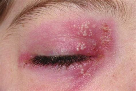 What Is Eye Herpes Causes And Treatment The Eye News