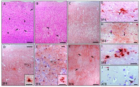 Neuropathological Findings A Frontal Cortex Hande Prominent