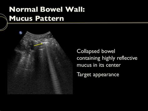 Emergency Ultrasound Bowel Pdf