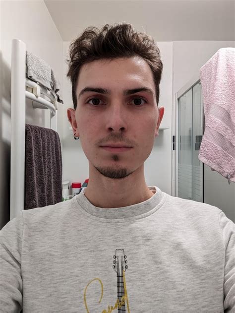 Ongoing Case Unilateral Condylar Hyperplasia Asymmetry Rjawsurgery