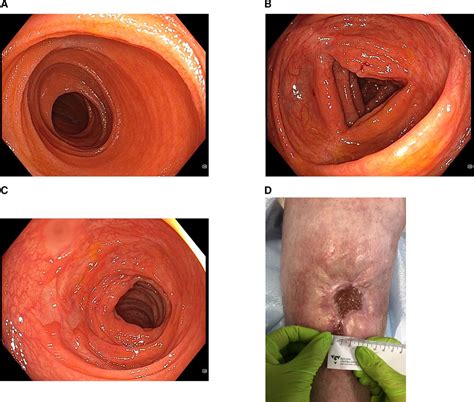 Pyoderma Gangrenosum As An Initial Presentation Of Crohns Colitis Bmj Case Reports