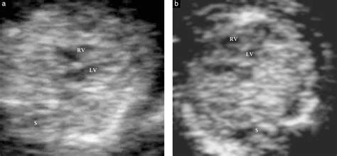Turners Syndrome In Fetal Life Surerus 2003 Ultrasound In