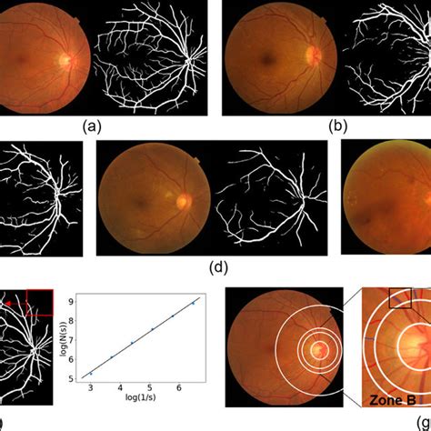 The Vessel Segmentation Results Of 2 Example Fundus Images The First