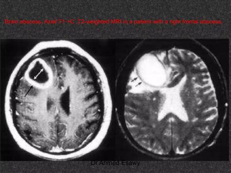 Intracranial Inflammatory Cystic Lesion Dr Ahmed Esawy Ct Mri Part 3 Ppt