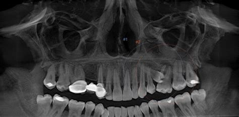Orthopantomograph Opg Showing Impacted 25 At Unusual Position
