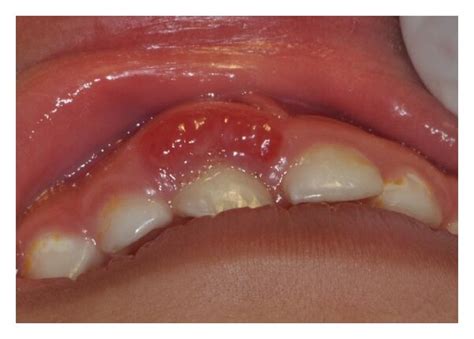 Clinical And Radiographic Appearances A Frontal View A Fiery Red