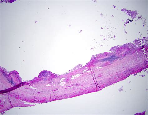 Pathology Outlines Acute Appendicitis