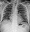 Chest X Ray Pulmonary Disease Pulmonary Fibrosis