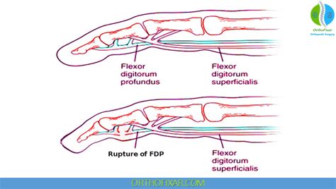 Flexor Digitorum Profundus Test