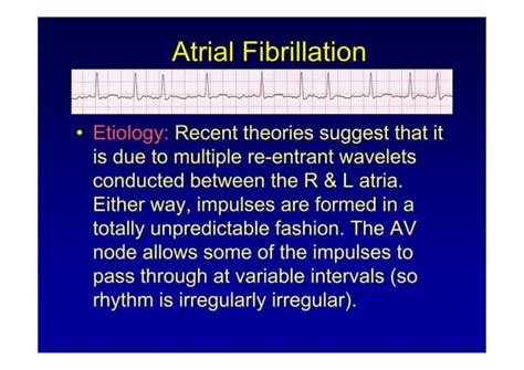 Ecg Rhythm Interpretation Ecg Rhythm Analysis Pdf
