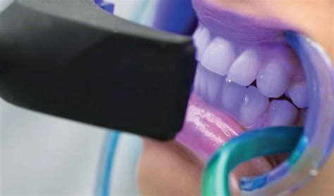 Tooth Bleaching Lifemed Dental