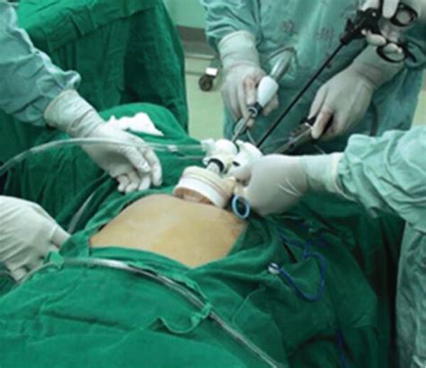 The Device Used In Single Port Laparoscopic Hepatic Left Lateral