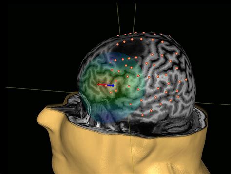Nexstim Neurosurgery