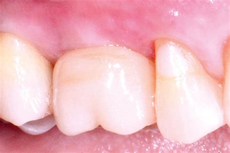 Posterior Socket Preservation Using Maxgraft® And Permamem® Dr C