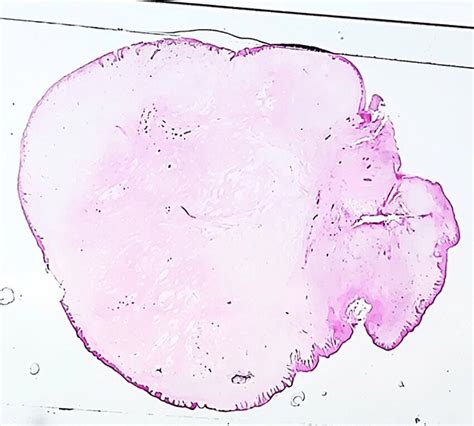 Histopathology Is Suggestive Of Cemento Ossifying Fibroid Epulis Download Scientific Diagram