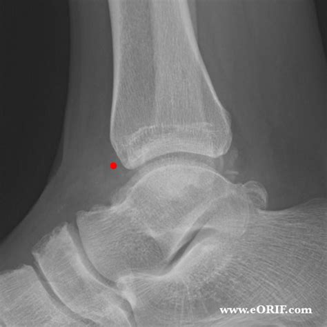 Anterior Ankle Impingement Images Eorif