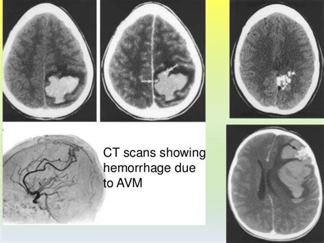 Arteriovenous Malformation Avm Of Brain
