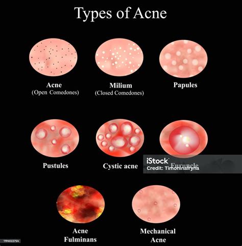 여드름 피부 염증의 종류 여드름 종기 흰 머리 닫힌 혜성 구진 농포 낭포성 여드름 인포 그래픽 검은 색 배경에 벡터 그림입니다 건강관리와 의술에 대한 스톡 벡터 아트 및
