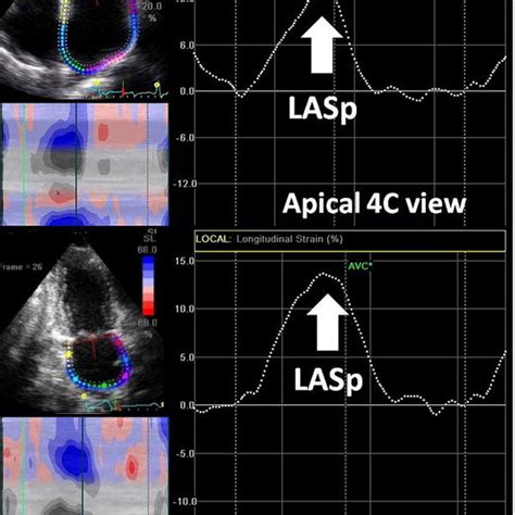 The Strain Curve From Speckle Tracking Echocardiography Of The Left