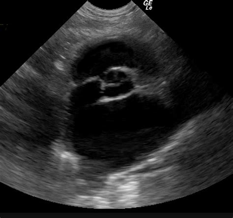 Echocardiography MettaSound