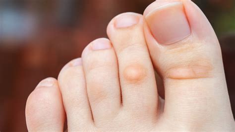 Corns On Toes