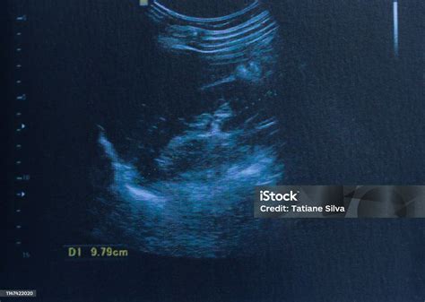신장 초음파 복부의 스캔 의료 영상은 신장을 보였다 X 레이에 대한 스톡 사진 및 기타 이미지 X 레이 건강 검진 건강