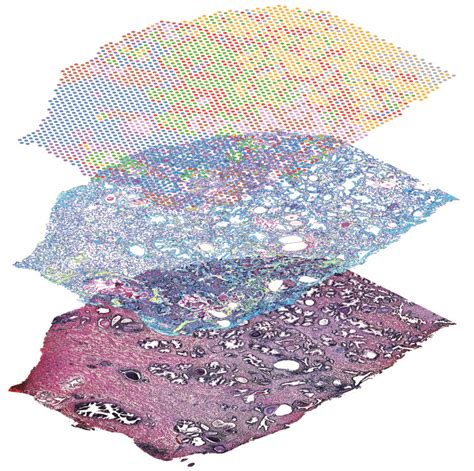 Spatial Transcriptomics Thrives On New Approaches Inside Precision Medicine