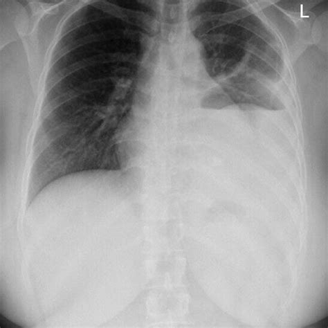 Cxr Pre Operative Initial Cxr At Presentation To Er Showing Download Scientific Diagram
