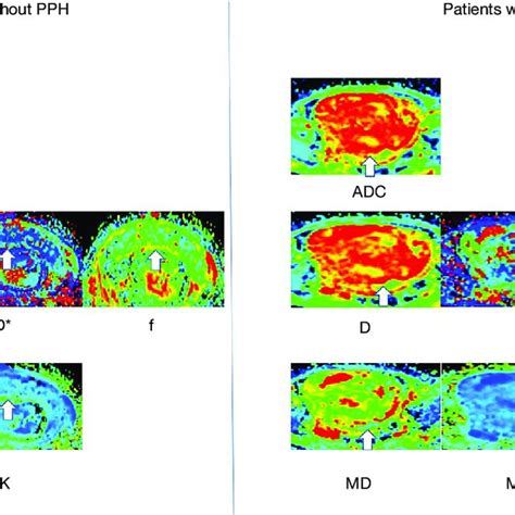 The Illustration Of Dwi Parameters In Patients With And Without Pph