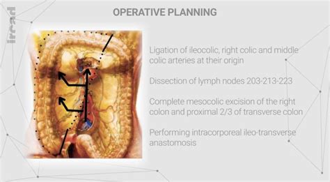 Laparoscopic Extended Right Hemicolectomy With D3 Lymphadenectomy A… Devendra Singh